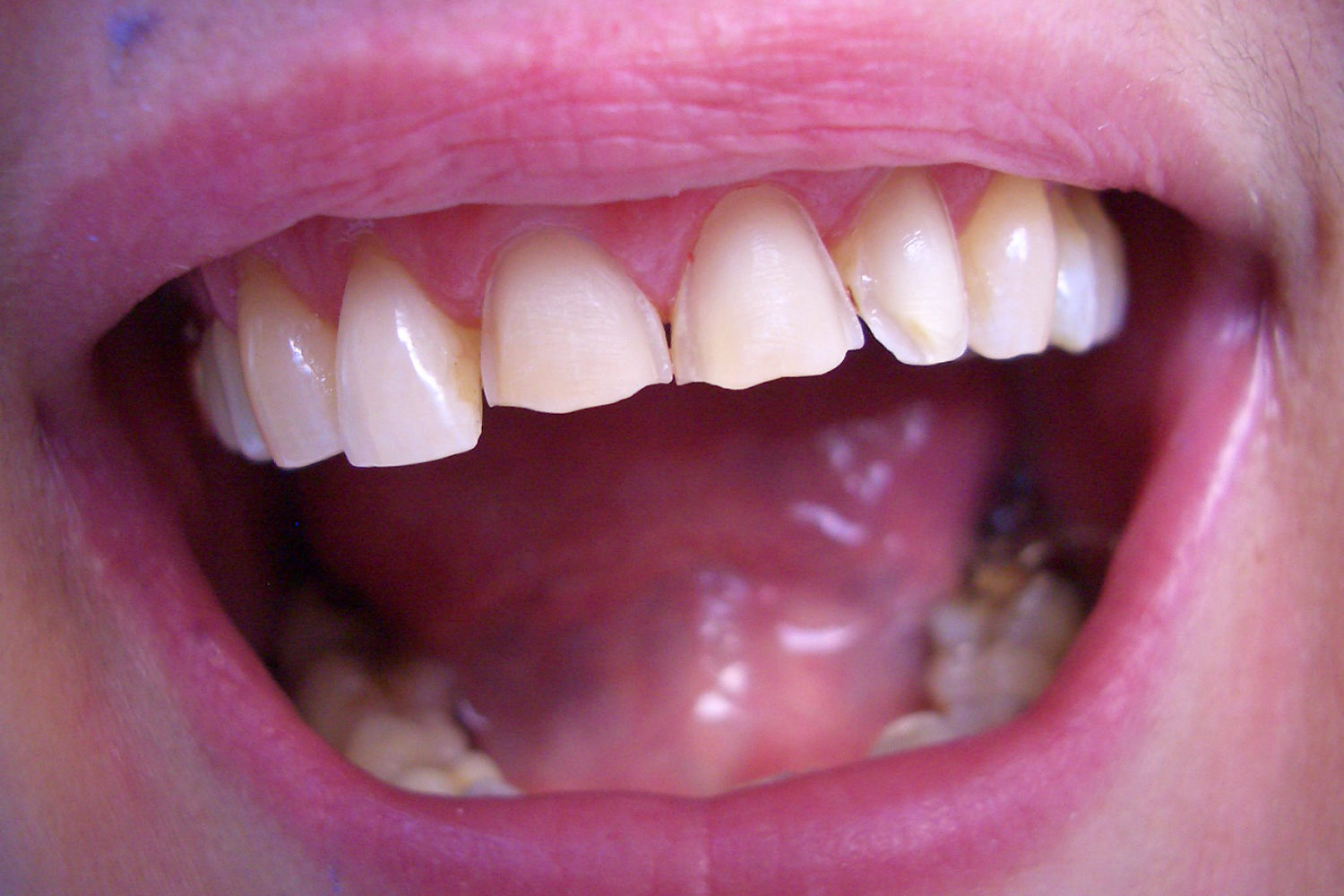 Prothèses traditionnelles – DUODENTAL, Laboratoire de prothèse dentaire ...
