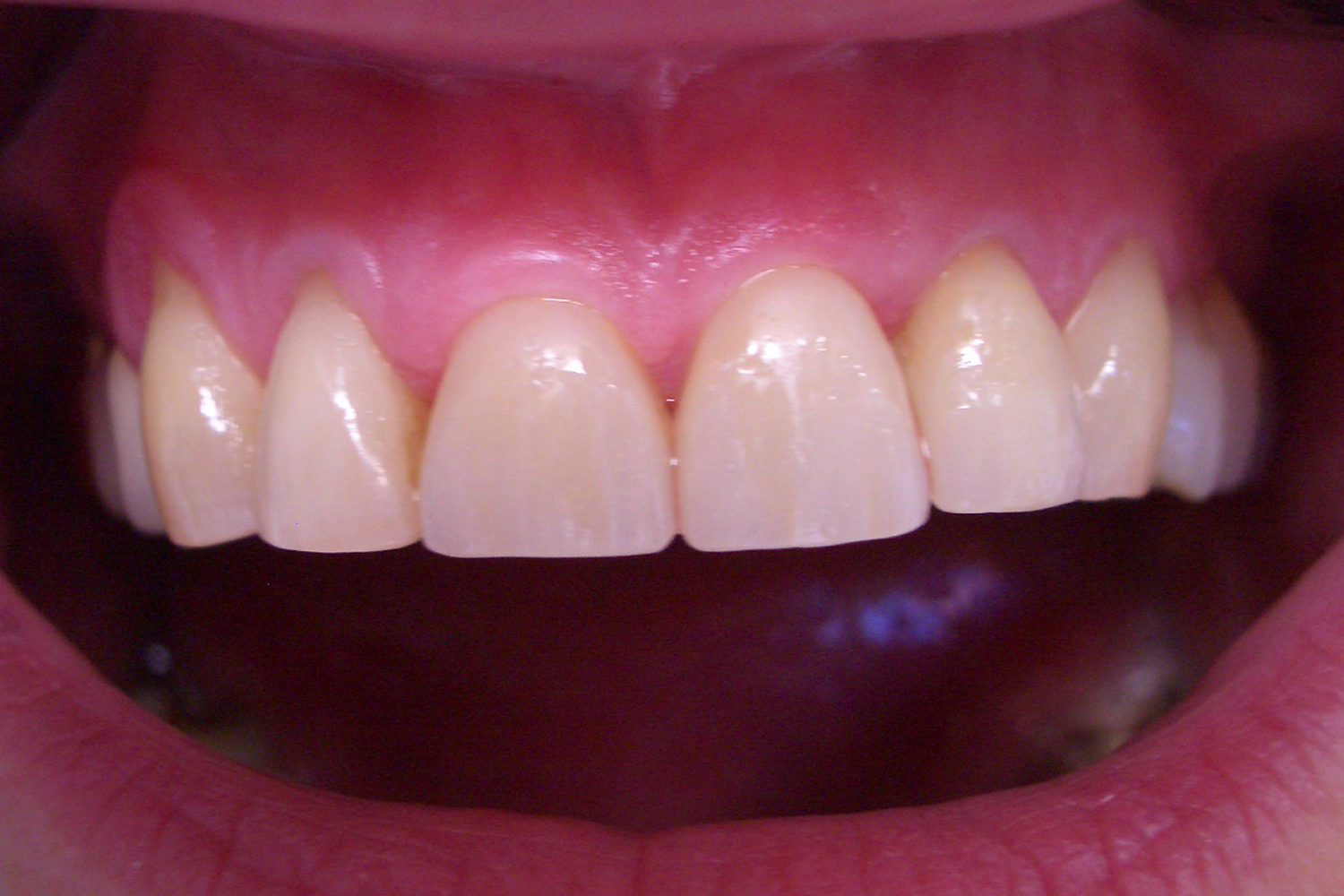 Prothèses traditionnelles – DUODENTAL, Laboratoire de prothèse dentaire ...